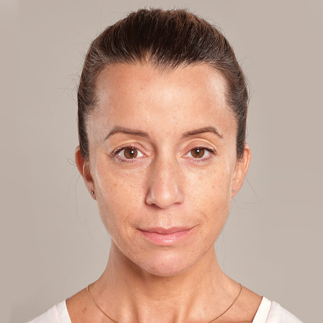 Dermal Fillers | Teoxane